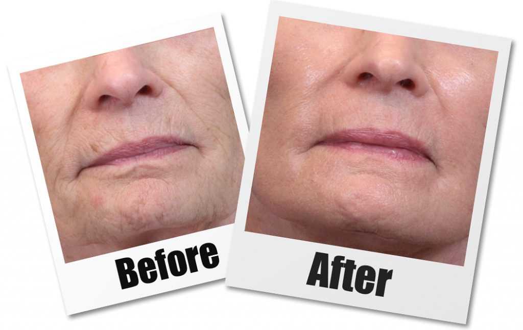 Facial Fat Transfer Seattle | Fat Transfer Cost | Seattle Plastic Surgery