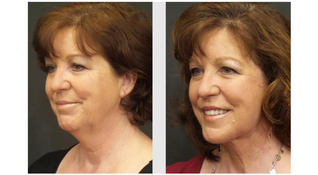 Facelift Revision Seattle & Tacoma | Seattle Plastic Surgery